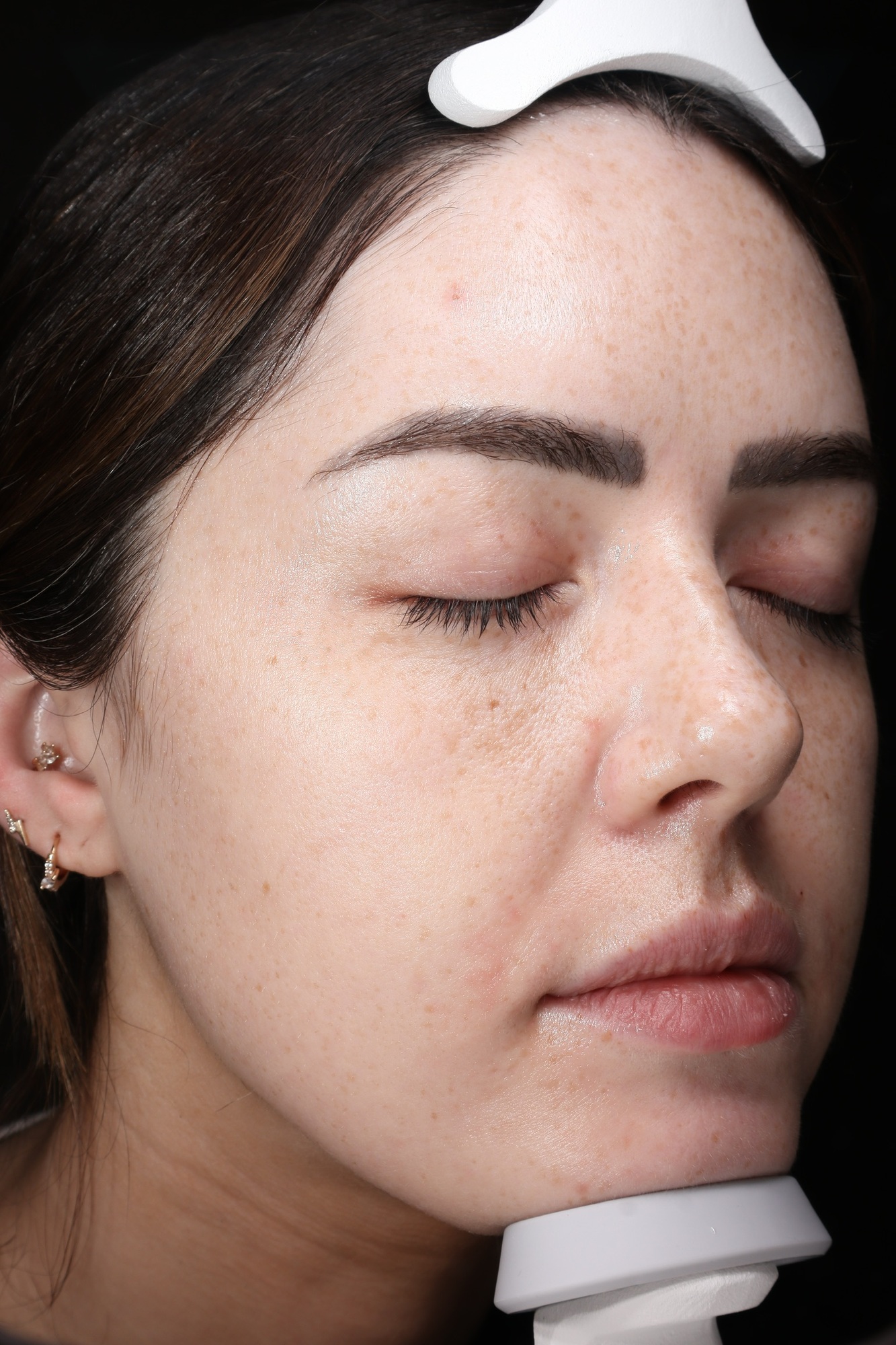 Moxi and BBL HERO combination treatment • Elinea