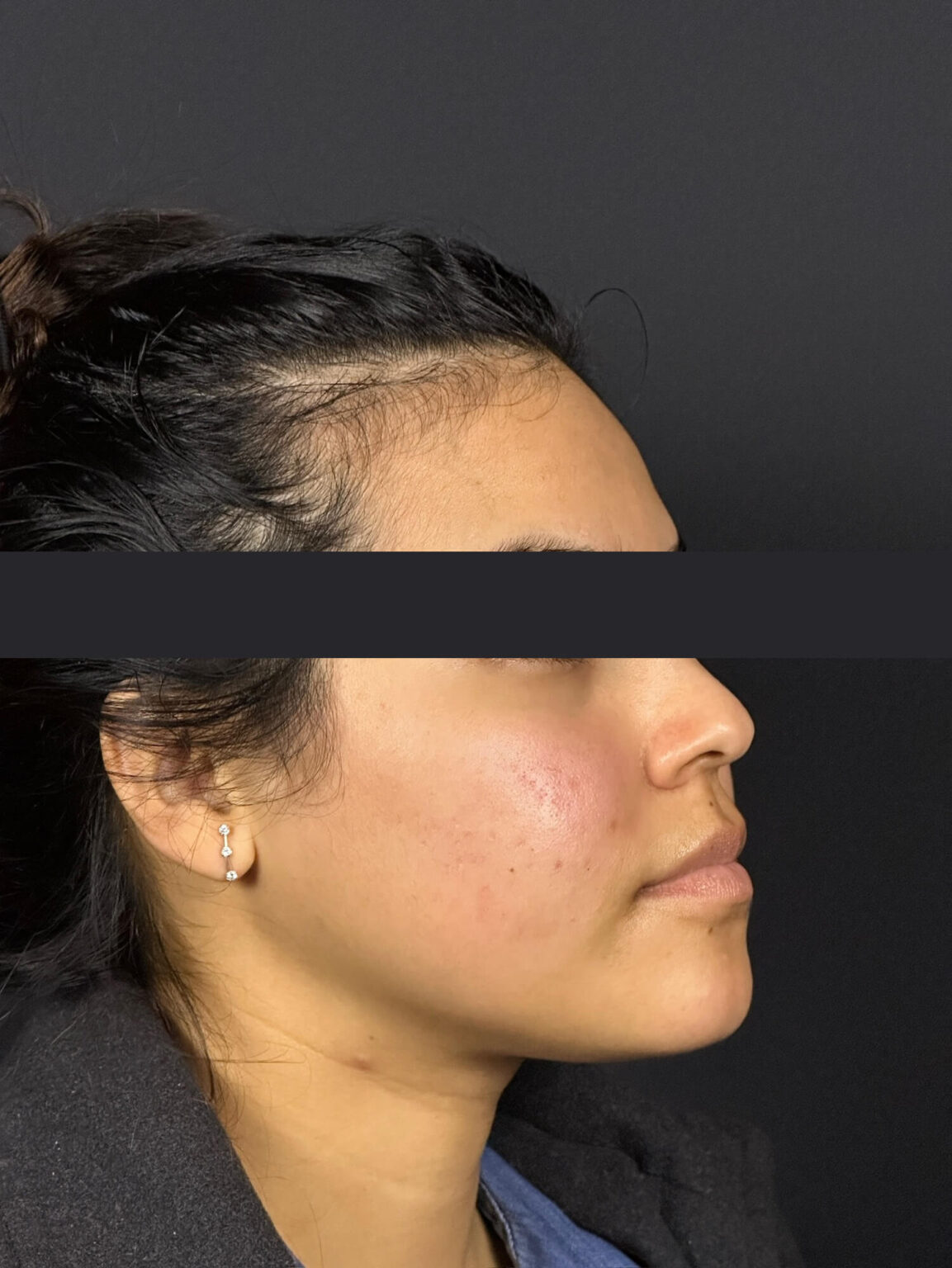 Customized acne scar treatment • Elinea